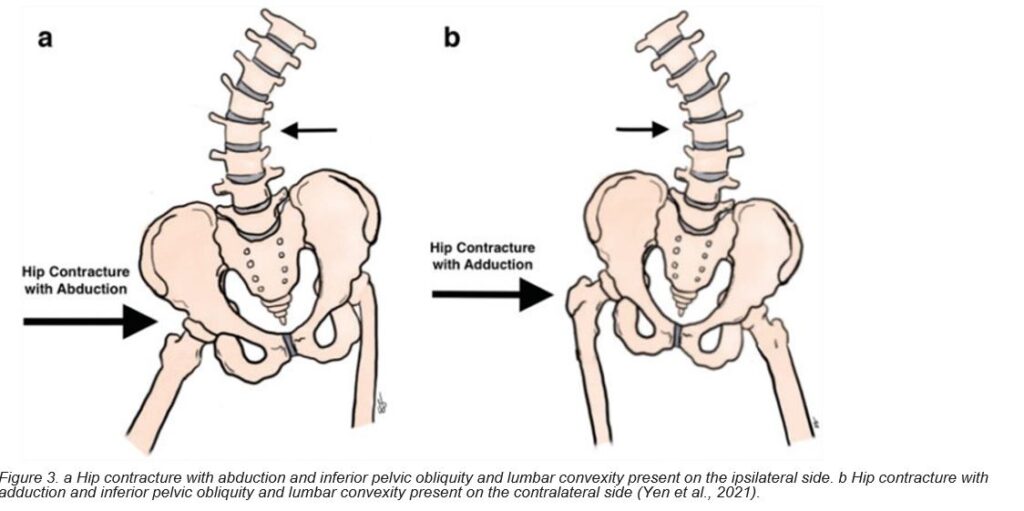 Postural stability and the effects of wheelchair cushions - Pelvic ...